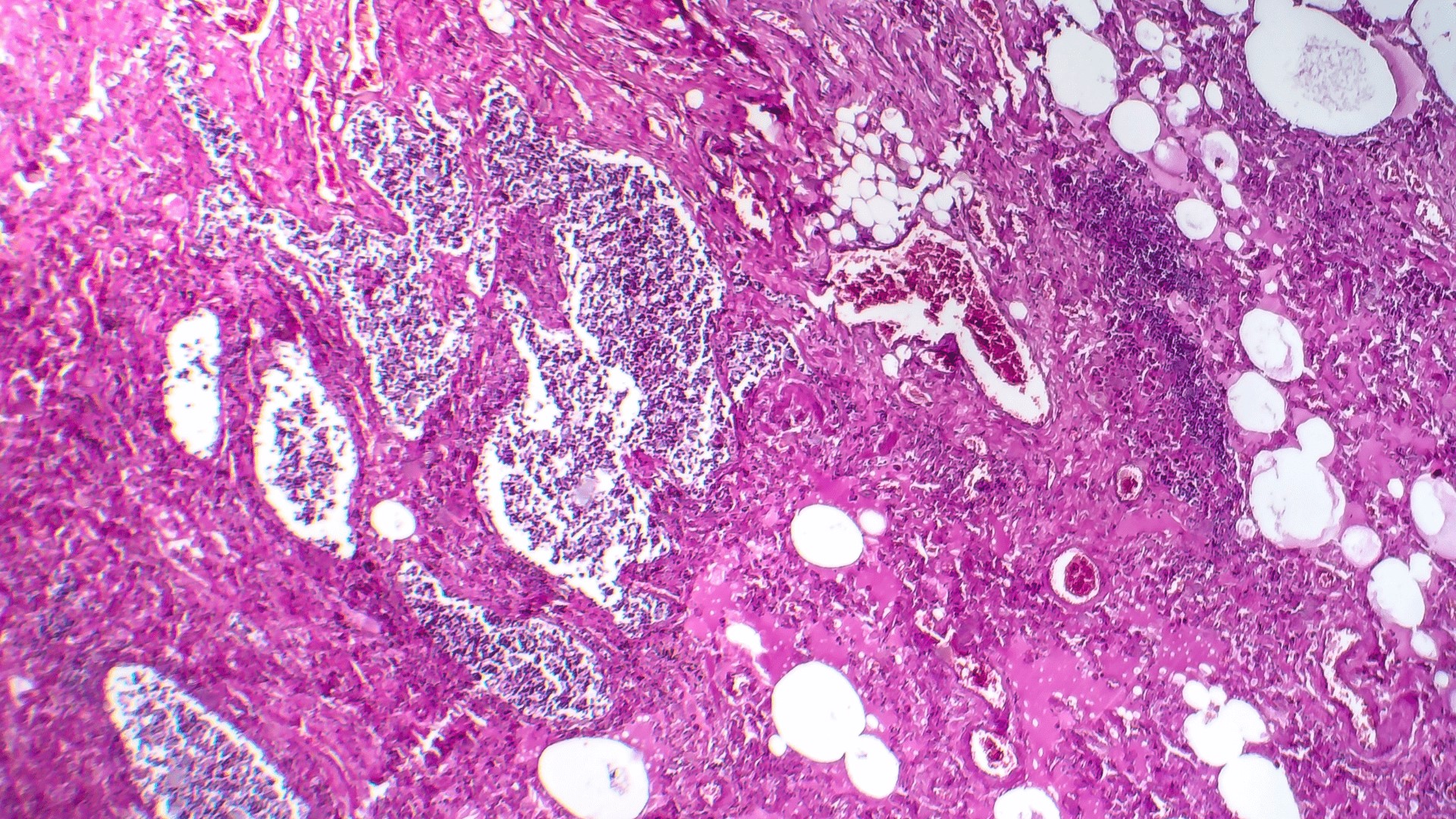 Europe’s Beating Cancer Plan – what’s at stake for lung cancer? - ERS ...